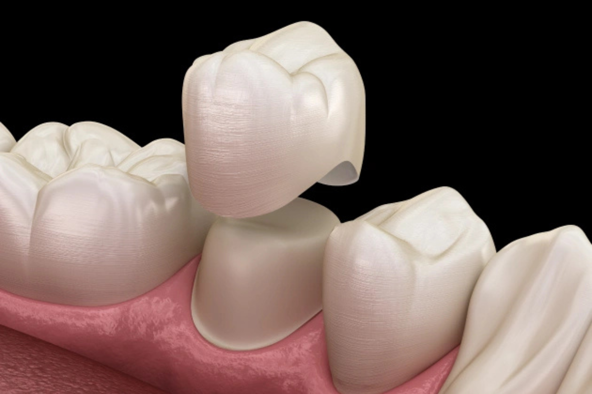 A Guide to Properly Maintain Your Dental Crowns